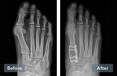 Lapiplasty® System Treace Medical Concepts Inchow The Lapiplasty