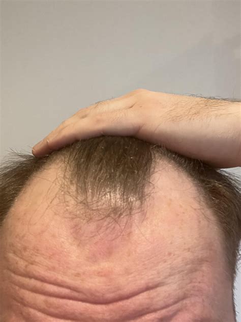 4000 Grafts Dr Serkan Aygin Rhairtransplants