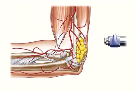 Ondas De Choque Fisioterapia Xirivella