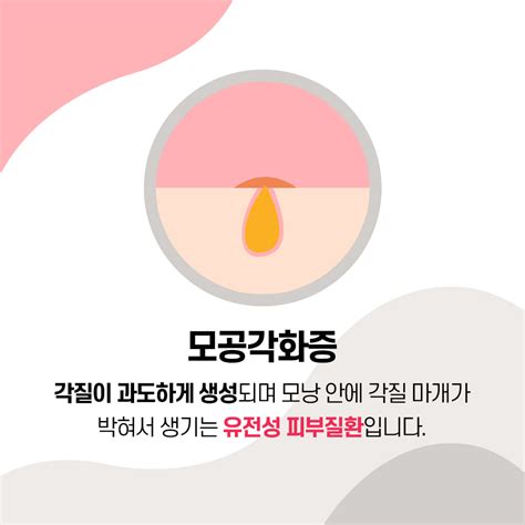 단한의원 닭살 돋은 피부 모공각화증 각질이 과도하게 생성되어 생겨요 각질층을 얇고 부드럽게