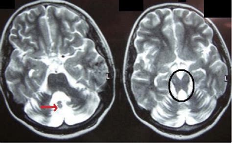 Axial T Weighted MRI Of The Brain Of Patient Number Two At The Level