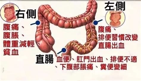 关于大肠癌 您了解多少