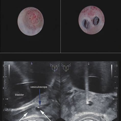 Endoscopic View Of Verumontanum A Prostatic Utricle Orifice And