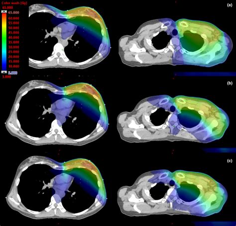 Dose Distribution Comparison An Example Dose Distribution Achieved By