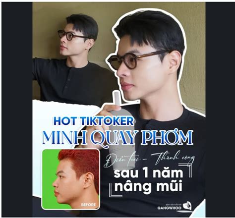 Hot Tiktoker Minh Quay PhƠm ĐiỂn Trai ThÀnh CÔng Sau HƠn 1 NĂm NÂng MŨi