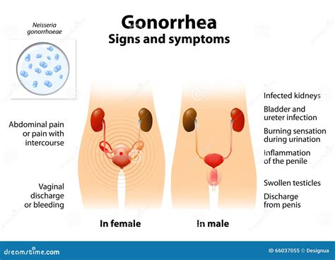 Gonorrhea Or Gonnococcal Infection Stock Vector Illustration Of