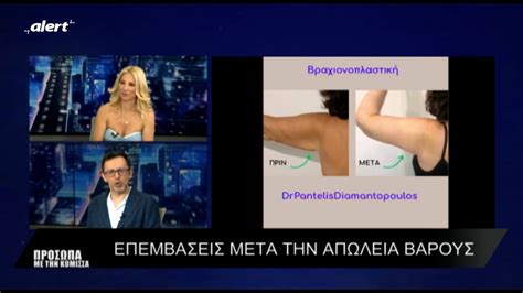 ΠΡΟΣΩΠΑ ΜΕ ΤΗΝ ΚΟΜΙΣΣΑ Επεμβάσεις μετά την απώλεια βάρους Youtube