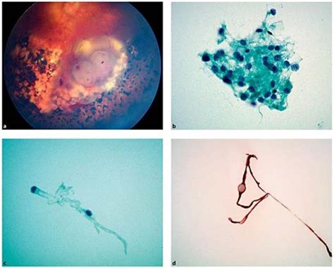 Reactive Retinal Astrocytic Tumor Focal Nodular Gliosis Report Of The Clinical Spectrum Of 3
