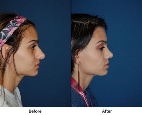 Case 7164 Before And After Result Photos