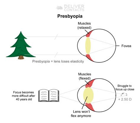 Presbyopia Definition Causes And Symptoms Deliver Contacts