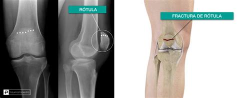Fisura En La Rodilla Tratamiento Online Varsana