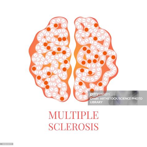 Multiple Sclerosis Conceptual Illustration High Res Vector Graphic
