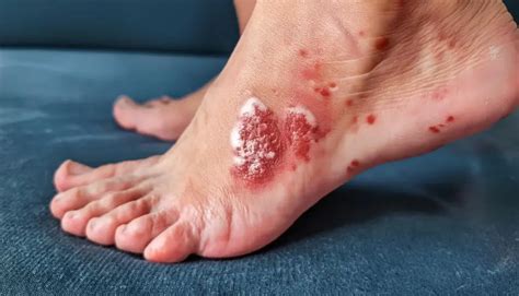 Can You Prevent Cellulitis Best Skin Care Tips For Healthy Skin