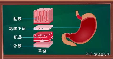 胃溃疡、胃炎的区别什么？傻傻分不清楚？别慌，从这5个方面进行鉴别 知乎