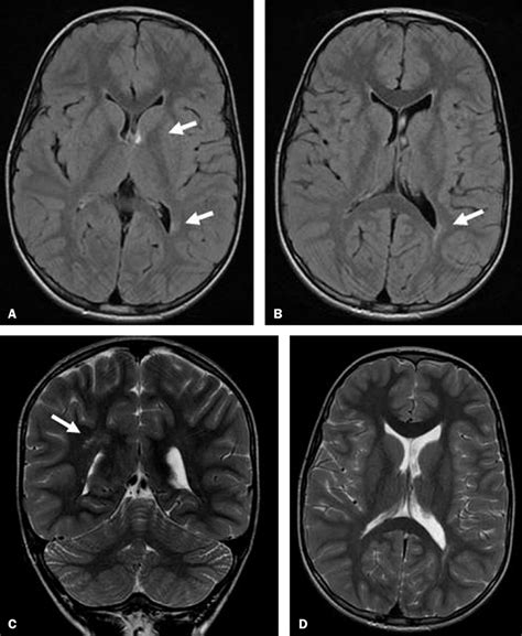 Left Lateral Ventricle Brain