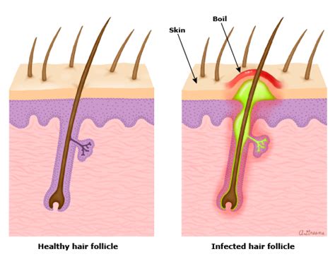 Ingrown Hair Cyst Symptoms Treatment Prevention And 50 OFF