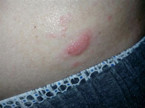 Красные пупырышки Вопрос дерматологу 03 Онлайн