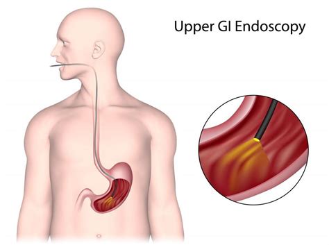 5 Different Types Of Endoscopy Gastroenterology Practice Located In Trinity FL Bay Area