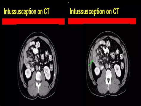Presentation1pptx Radiological Imaging Of Intusussception Pptx