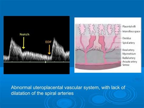 Antenatal Doppler Ppsx