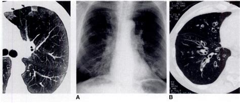 Cryptogenlc Bronchiolitis Obliterans In A 60 Year Old Man