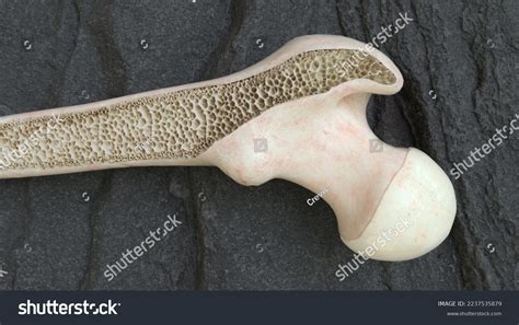 Osteoporosis Thigh Bones Inside 3d Rendering Stock Illustration