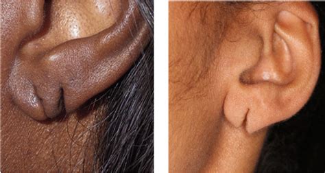 Torn Earlobe Due To The Heavy Weight Of Earrings Source Download