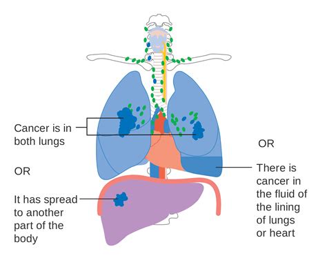 Different Types Of Lung Cancer Cancerwalls
