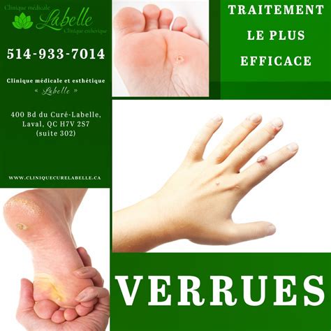 Élimination Des Verrues Par Thérapie Laser à Lazote Liquide