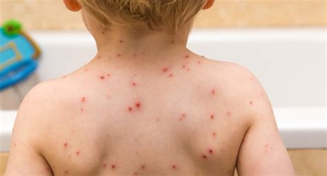 Measles Causes Symptoms Treatment Complications And Prevention Nigerian Health Blog