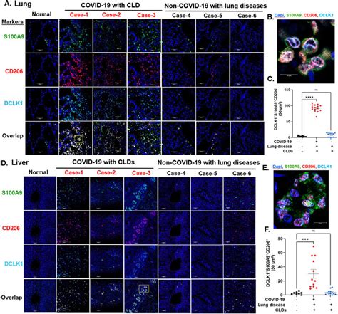 Dclk1 And S100a9 Coexpressing Immunosuppressive M2 Macrophages Cd2061