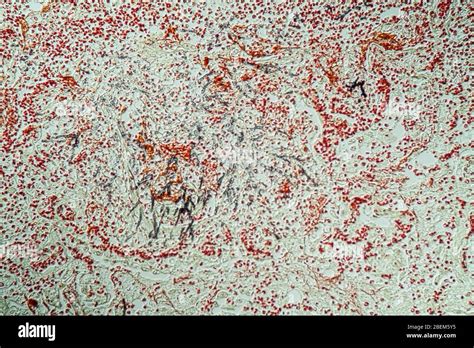 Lungs Infection With Candida And Aspergillus In Aids Patients 200x