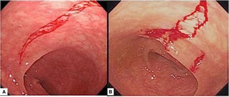 Collagenous Colitis Diagnosed By Endoscopically Induced Mucosal Tears