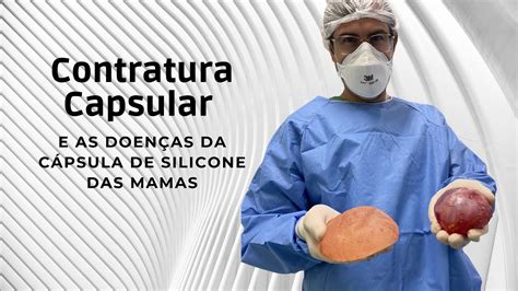 Contratura Capsular E Doen As Do Silicone Dr Francisco Claro Jr Youtube
