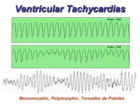 Monomorphic Vs Polymorphic Ventricular Tachycardia Strip Ventricular