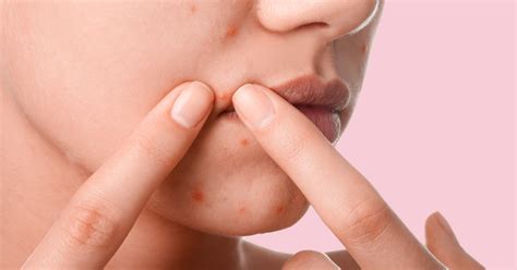 Acne Vulgaris Types Symptoms And Treatment Ova SG