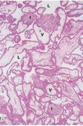 Obgyn Path Placenta Flashcards Quizlet