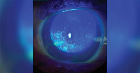 Superficial Punctate Keratitis