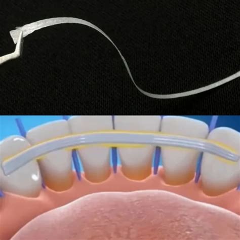 1pcs Dental Material Flexible Fiber Strip Glass Splint Loose Tooth