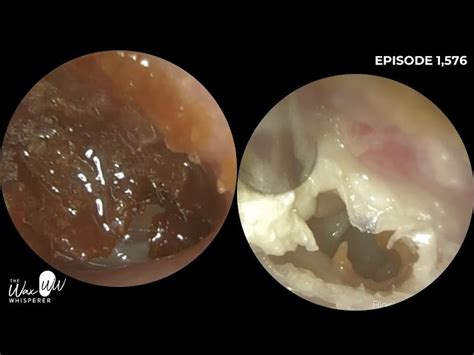 Malignant Otitis Externa Malignant Otitis Externa With Ecthyma