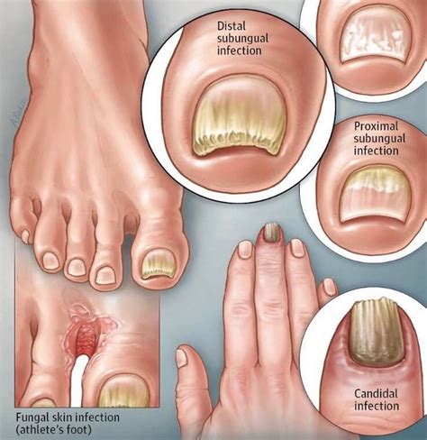 Miss Foot Fixer Types Of Fungal Nail Infections 🦠👣 If
