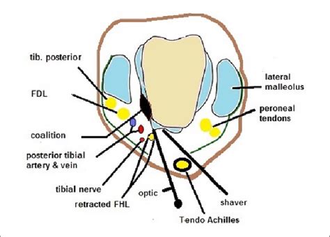 Schematic View For The Arthroscopic Approach To The Posterior Facet And