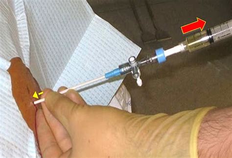 Best Practices Paracentesis