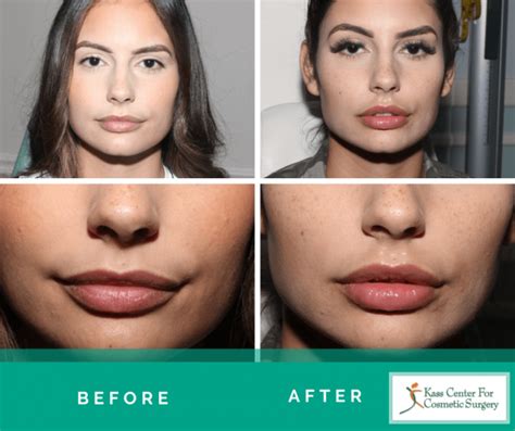 Botox In The Lips Before And After