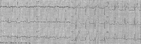 Should We Activate The Cath Lab If The Stemi Is Spontaneously Reperfused Dr Smiths Ecg Blog