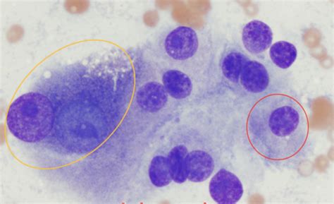 Amelanotic Melanoma Cytology