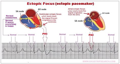 What Is A Ventricular Escape Beat
