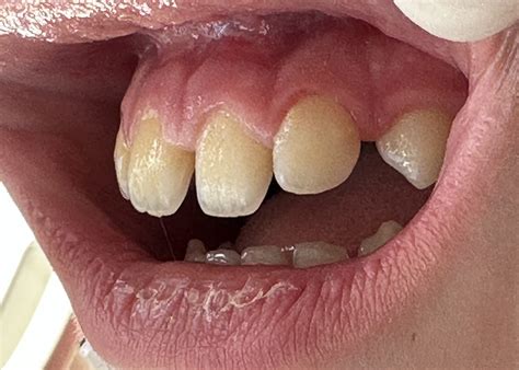 Frenulectomy Zoe Filokosta Dental Implants