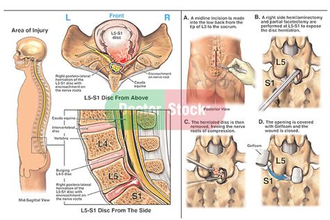 Partial Facetectomy