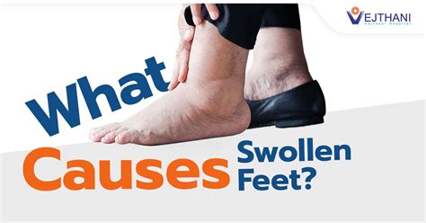 What Causes Swollen Feet
